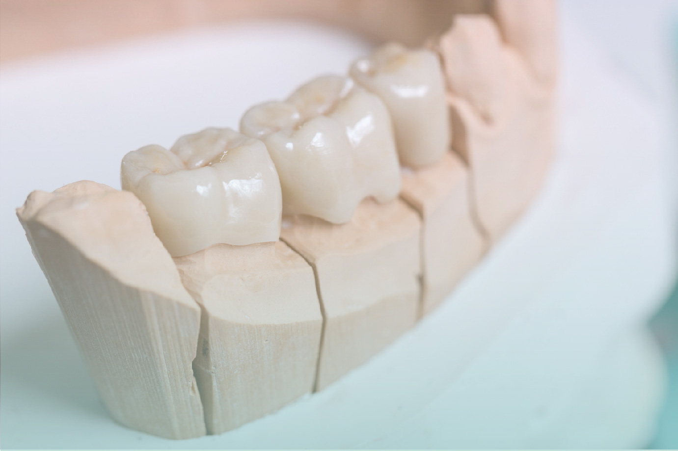 Emax Crown | Durable & Natural-Looking Dental Crown